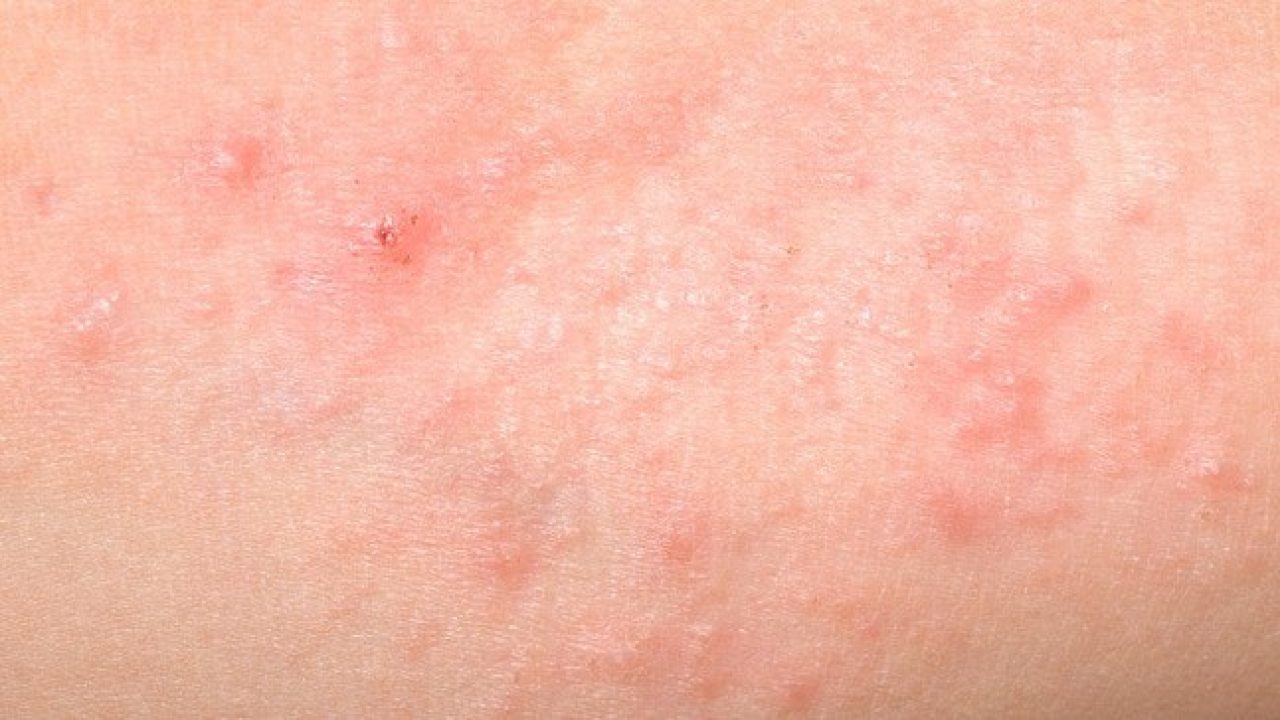 How to treat heat rash - Ang Pinoy